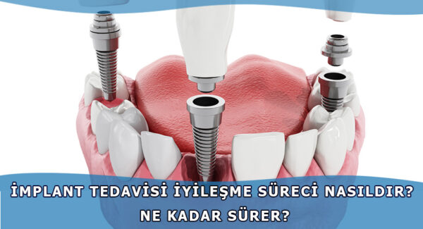 İmplant Tedavisi İyileşme Süreci Nasıldır? Ne kadar Sürer?