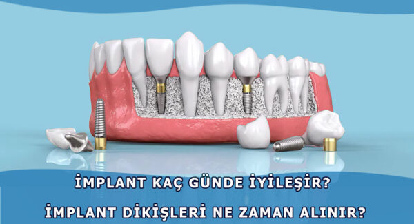 İmplant Kaç Günde İyileşir? İmplant Dikişleri Ne Zaman Alınır?
