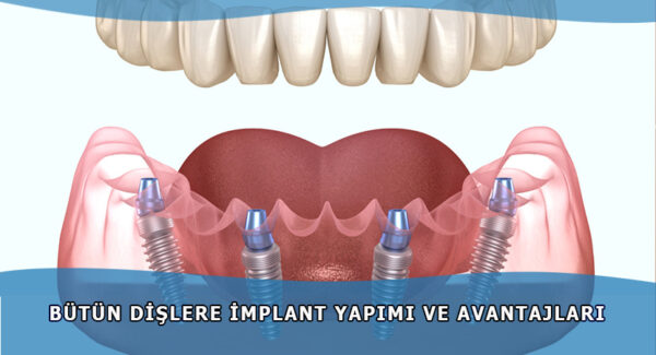 Bütün Dişlere İmplant Yapımı ve Avantajları - Dt. Deniz Duraklıoğlu