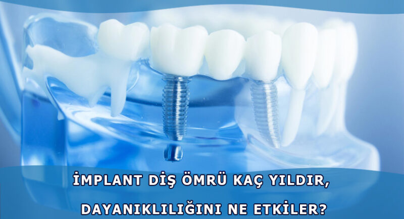 İmplant Diş Ömrü Kaç Yıldır, Dayanıklılığını Ne Etkiler? - Dt. Deniz ...